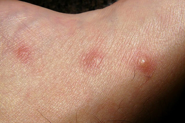 Do Termites Bite People? What do you need to know?